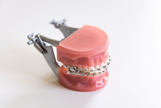 Soorten beugels | Mignon van Loenen, orthodontist