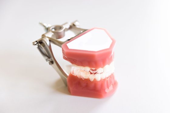 Soorten beugels | Mignon van Loenen, orthodontist